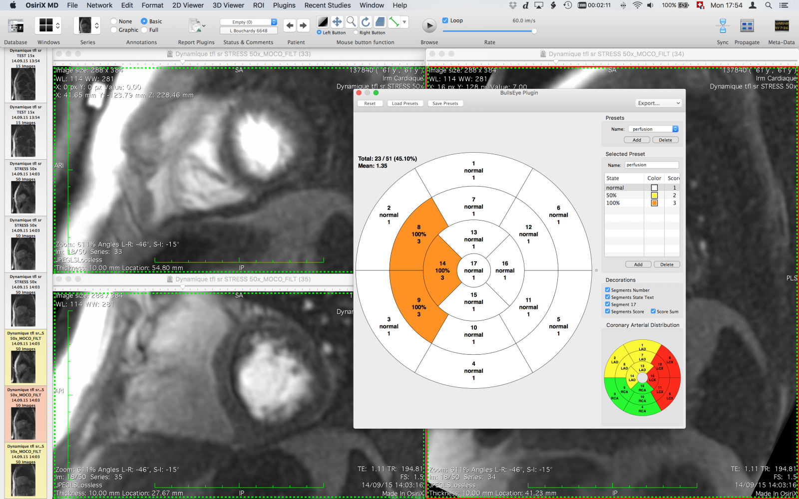 OsiriX DICOM Viewer | Plugins