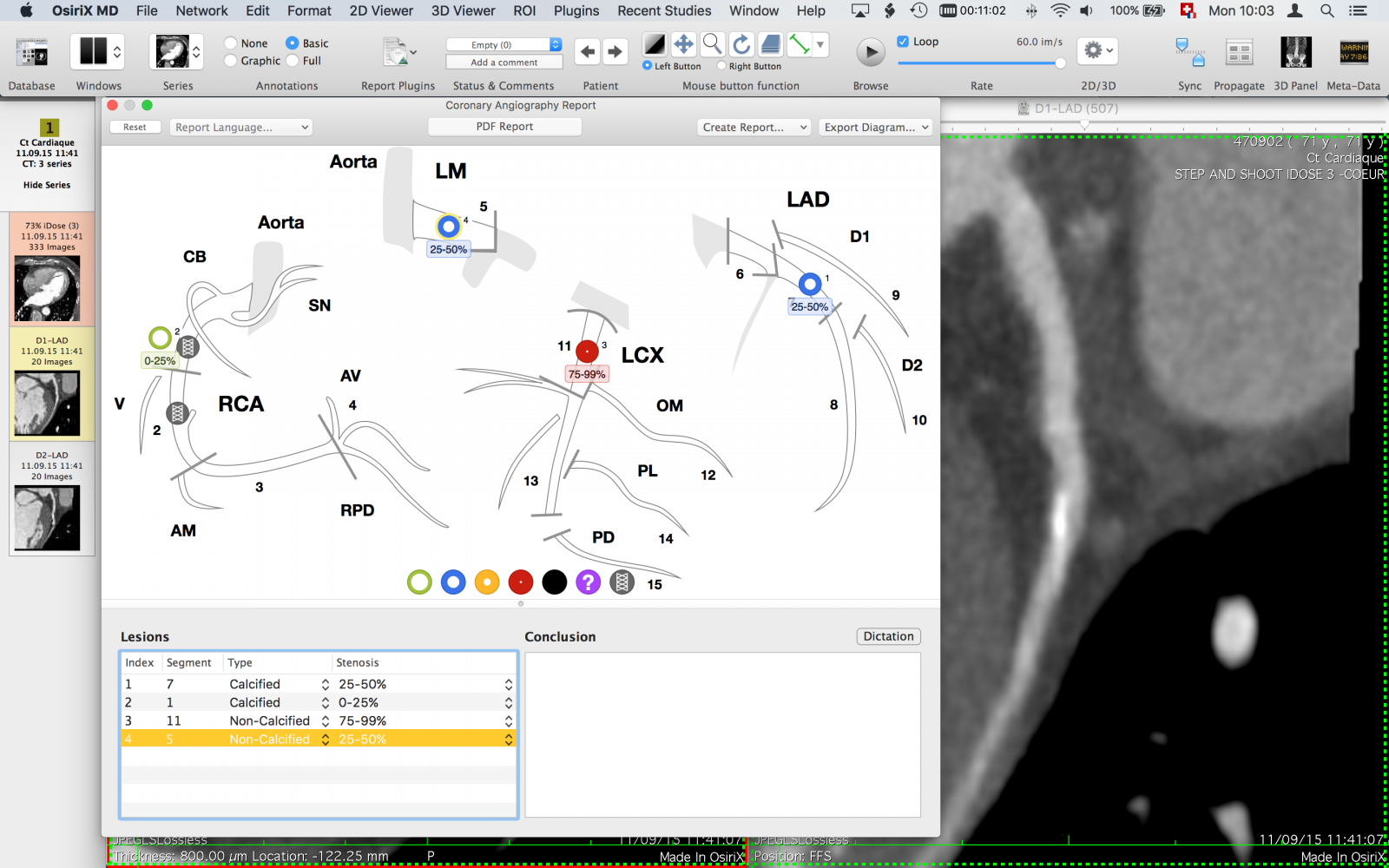 OsiriX DICOM Viewer | Plugins