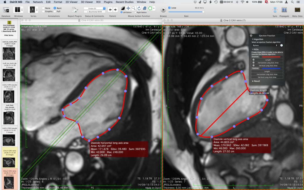 OsiriX DICOM Viewer | Plugins