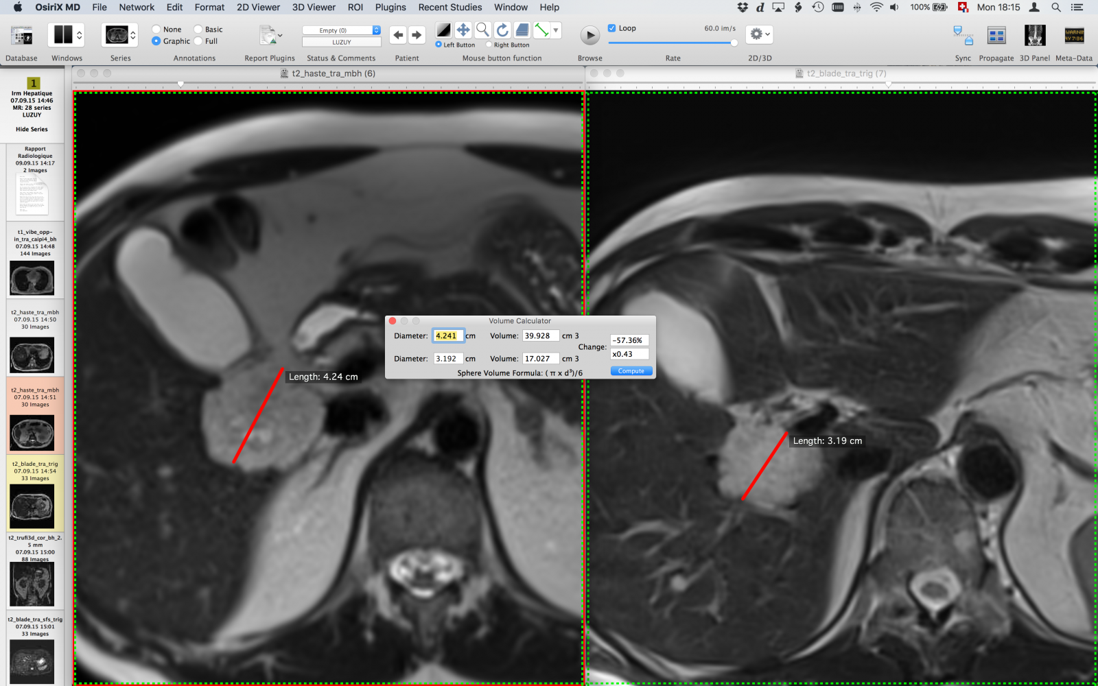OsiriX DICOM Viewer | Plugins